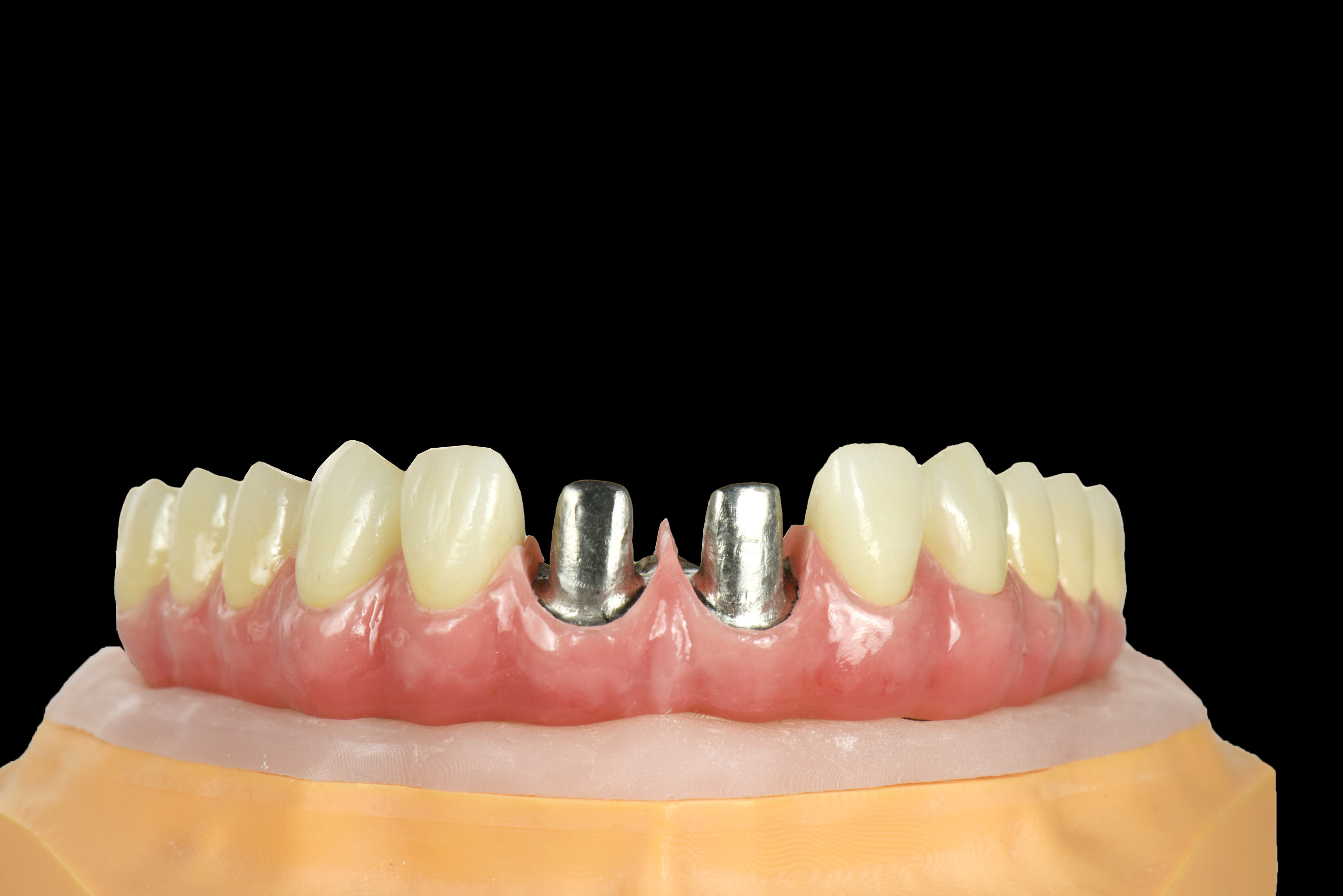 FDA Titanium Bridge Dental Implant Titanium Framework With Crown
