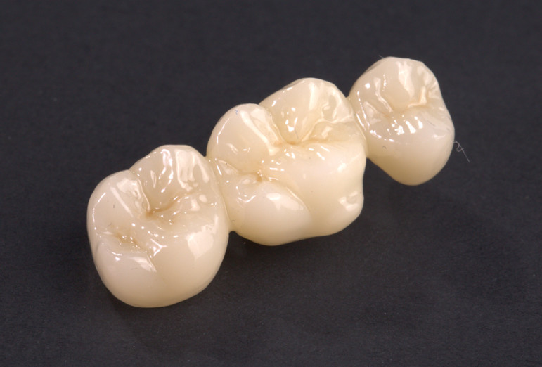 Precise Fit Full Contour Zirconia Bridge Natural Zirconia Crown Bridge ...