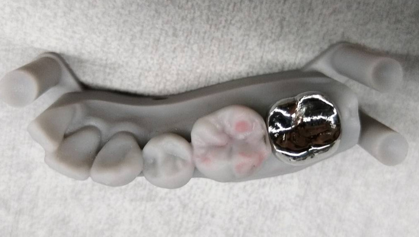 Full Metal Non Precious Crown Implant PFM Crown And Bridge Professional